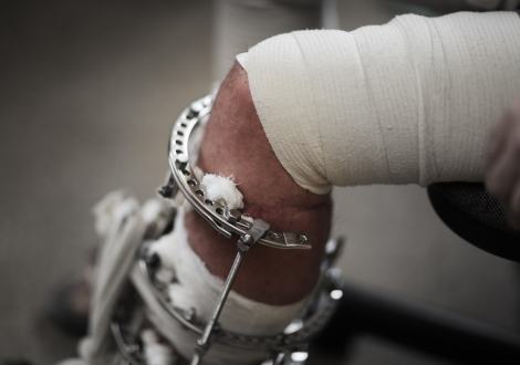 What You Need to Know About Limb Reconstruction System ...